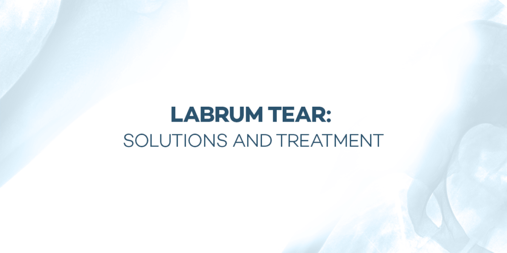 labrum tear – AOC